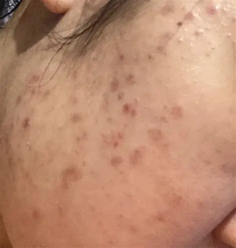 สิวหายหน้าใสภายใน2 3เดือนดีขึ้นแน่นอน No Sponsor แกลเลอรีที่โพสต์โดย Creammss Lemon8