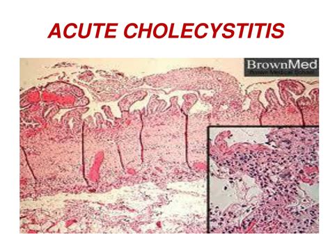 Ppt Acute Cholecystitis Powerpoint Presentation Free Download Id 9542556