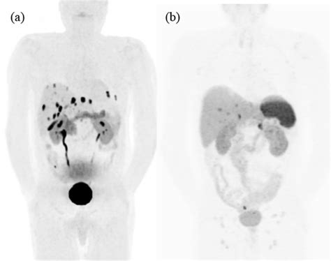18f Dopa Petct Mip A And 68ga Ha Dotatate Petct Mip B Performed