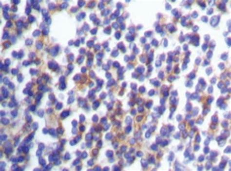 Light Chain Restriction Kappa Restriction In A Case Of Chronic Download Scientific Diagram
