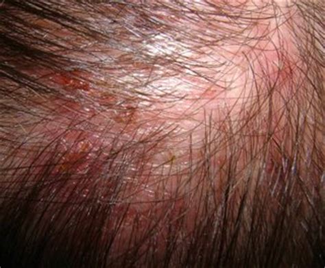 VIRTUAL GRAND ROUNDS IN DERMATOLOGY 2 0 Folliculitis And Hair Loss