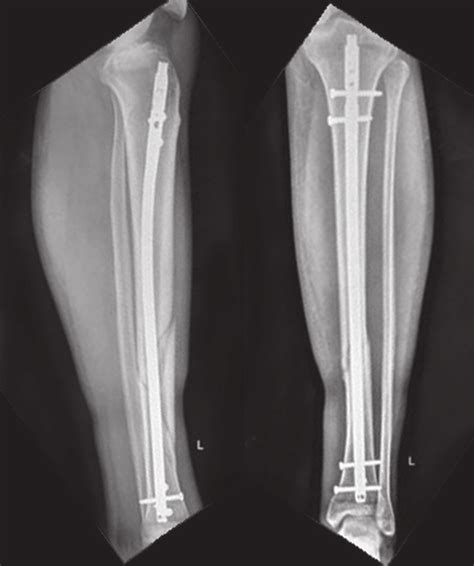 Radiographs Of Tibia Produced On The Day The Patient Presented To The Download Scientific