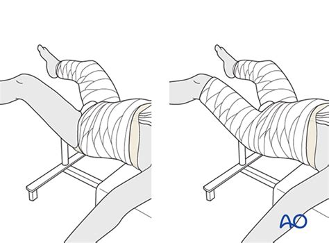 Double Hip Spica Cast Hip Spica Cast For Femur Fracture