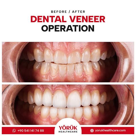 Dental Veneers Are Shells Of Yörük Healthcare Facebook