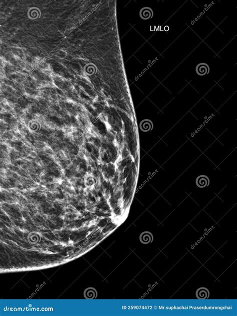 Breast Cancer Digital Mammogram