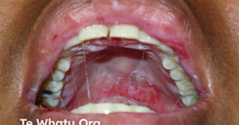 Behçet Disease Image