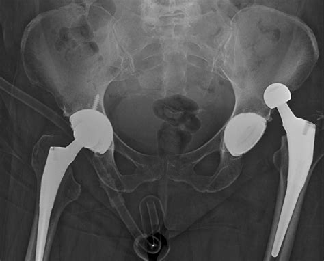 Left Tha Dislocation R Radiology