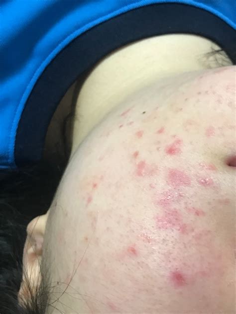 친구가 술을 마시고 얼굴에 붉은 반점이 생겼어요 지식in