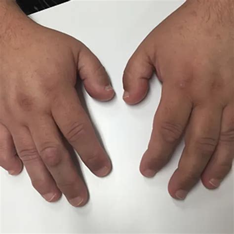 Book Pseudohypoparathyroidism Package Test Price In Delhi India Ganesh Diagnostic