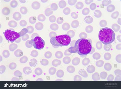 What Are Atypical Lymphocytes