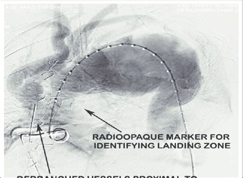 Aortic Root Angiogram Pre Evar Indicating The Debranched Vessels And