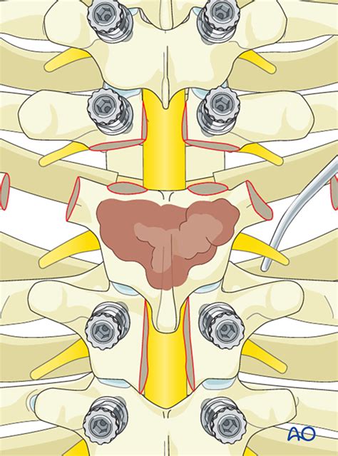 En Bloc Resection Of A Posterior Tumor T1 To T12 For Malignant