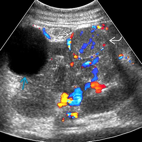 Renal Angiomyolipoma Radiology Key