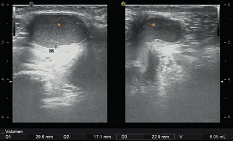 Bartholin Cyst Perineum
