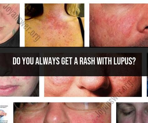 Lupus Rash Understanding Symptoms And Variations