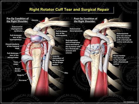 Full Thickness Rotator Cuff Tear
