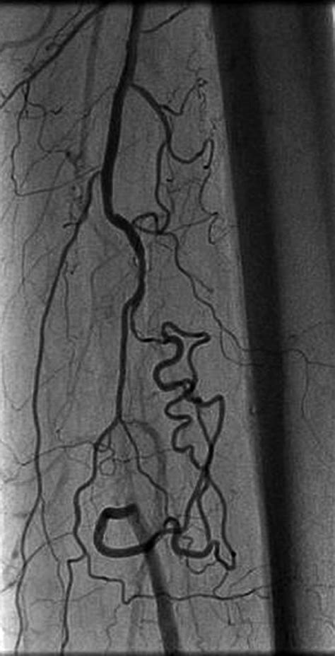 Total Occlusion Of The Left Superficial Femoral Artery Sfa Ryc 1 Download Scientific