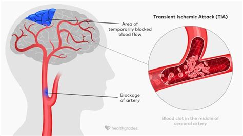Tia Strokes Symptoms Treatments And Prevention