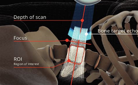 REMS Bone Density Scan Sydney Safe Accurate Testing