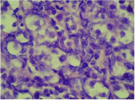 What Is Gonadoblastoma Pathosomes
