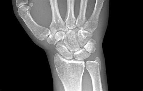 Hamate And Hook Of Hamate Fractures Hand Surgery Resource