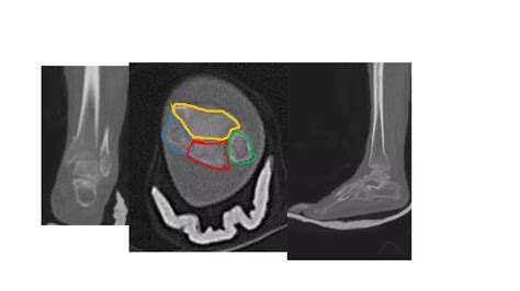 Ankle Fracture Posterior Malleolar Fractures Pptx
