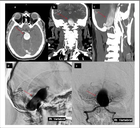 Figure 1 From Super Giant Fusiform Basilar Artery Aneurysm Semantic