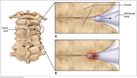 Joint Dysfunction Subluxation Misalignment Of The Cervical Spine Joint Dysfunction Subluxation Misalignment Of The Cervical Spine