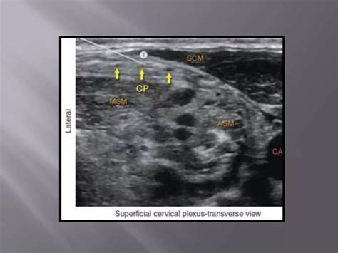 25820 Cervical Plexus Block 1 Pptx