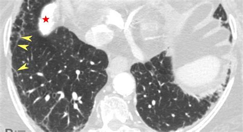 Rit Radiology Asbestosis