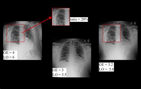 Score Correlated Cutmix Method Applied On A Cxr Image Download
