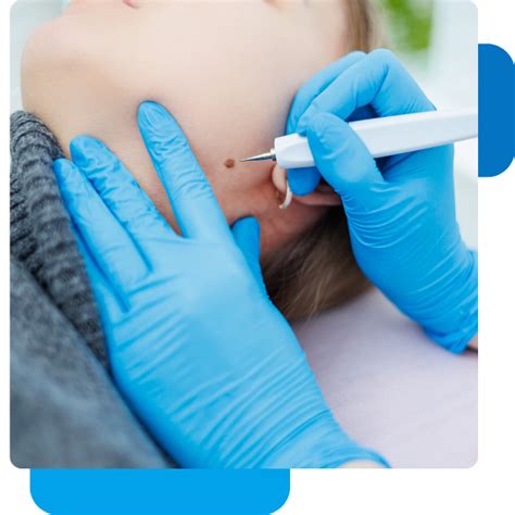 Benign Lesion Removal Contact Affinity Dermatology In Frisco