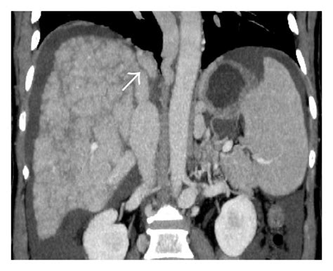 Gray Scale Us A And Coronal Mip B Images Demonstrating An Ivc Web