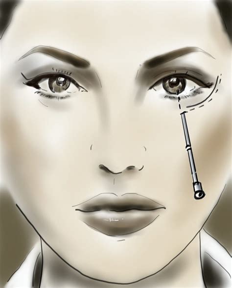 Trigeminal Nevralji Prof Dr Fuat Güldoğuş