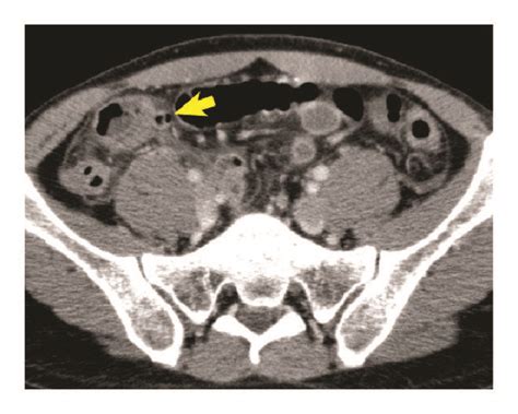 Computed Tomography Revealed Diverticula In The Terminal Ileum Arrow Download Scientific