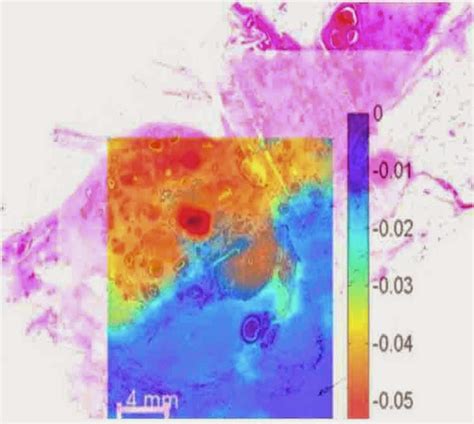Terahertz Imaging Of Breast Tumours
