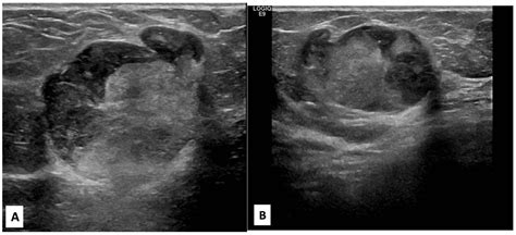 Diagnostics Free Full Text Initial Imaging Findings Of Breast Liposarcoma A Case Report