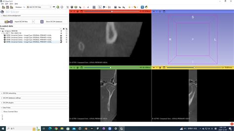 Error Image Slices Are Not Equally Spaced When Loading DICOM Files In D Slicer Support D