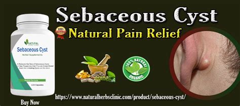 Sebaceous Cyst Prevention The Most Effective Ways To Stop From Forming