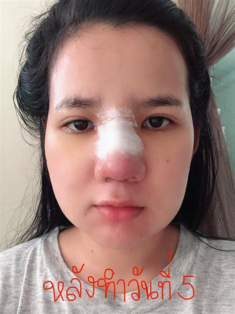 รีวิวแก้จมูกใหม่ ครบ 3 เดือนแย้ววว Dr Alex