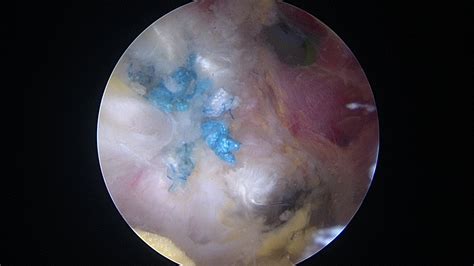 Hamstring Tendon Tears And Surgical Repair — Kevin Parvaresh Md