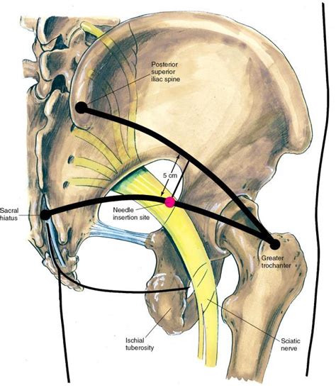 Sciatic Block Clinical Tree