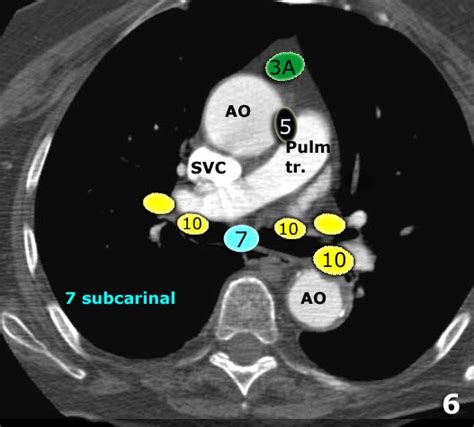 The Radiology Assistant Mediastinum Lymph Node Map