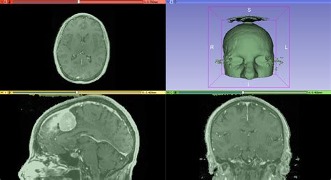 Overview 3d Slicer Segmentation Recipes