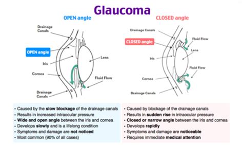 Acute Angle Closure Glaucoma Fundoscopy Acute Angle Closure Glaucoma Fundoscopy