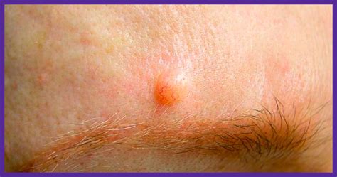 Нарости на шкірі фото та назви утворень МЦ Лазерсвіт