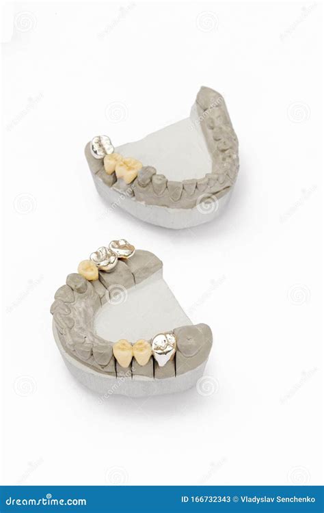Metal Ceramic Dental Crowns And Bridges Dental Prosthetics Artificial