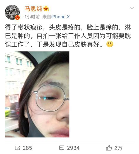 额头带状疱疹图片 单纯疱疹和带状疱疹图 带状疱疹图片 大山谷图库