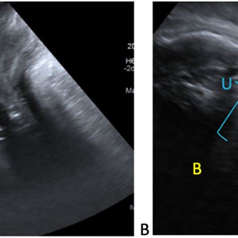 A Ultrasound Demonstrating Proximal Urethral Stricture With