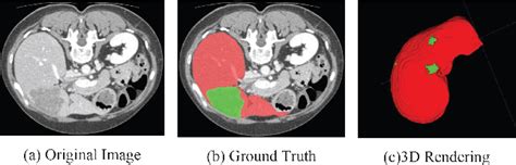 Figure 1 From Three Direction Fusion For Accurate Volumetric Liver And Tumor Segmentation
